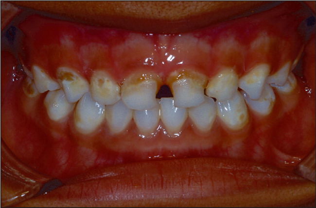 Oral health care in children – BJN Inform